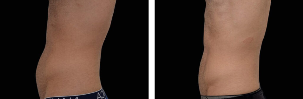 Emsculpt Neo in Annapolis, MD | Sullivan Surgery and Spa