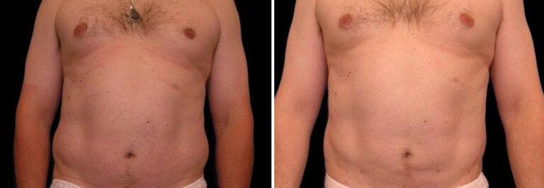 Liposuction for Men | Annapolis and Easton, MD | Sullivan Surgery and Spa